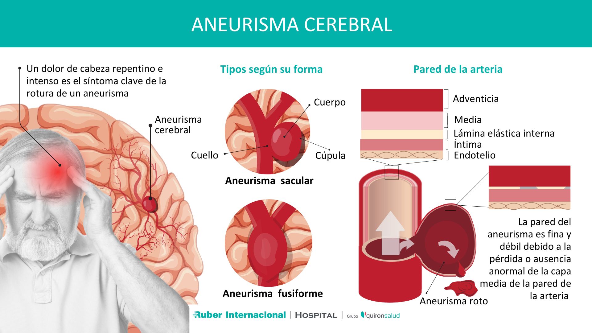 Aneurisma cerebral: Tratamiento endovascular mínimamente invasivo